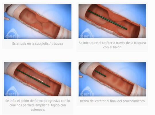 Estenosis subglótica - Dr. Manuel Gil